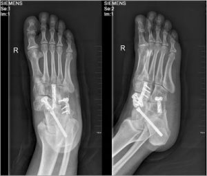 Rafael Nadal – Mueller-Weiss Syndrome - Healthy Foot Centre