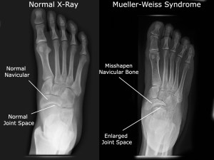 Rafael Nadal – Mueller-Weiss Syndrome - Healthy Foot Centre